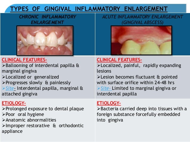 Gingival Enlargement