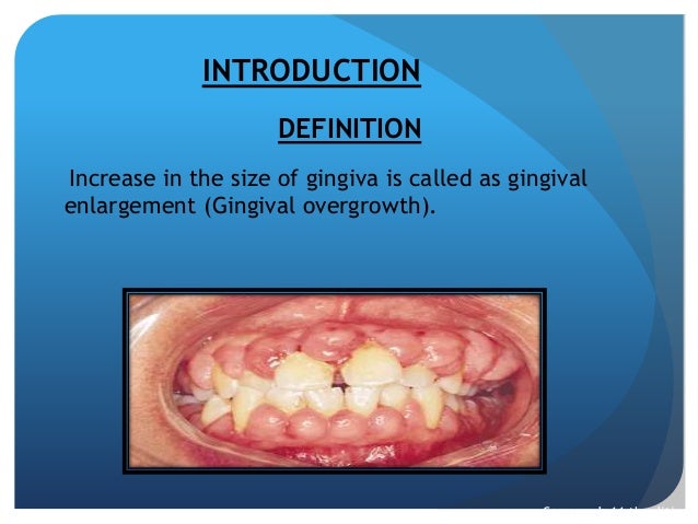 Gingival Enlargement