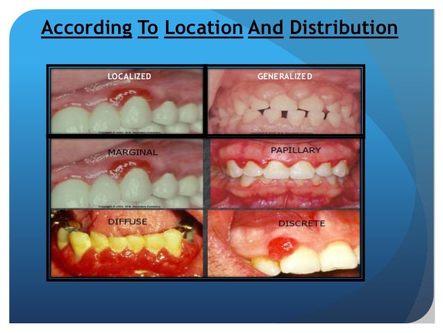 Gingival Enlargement
