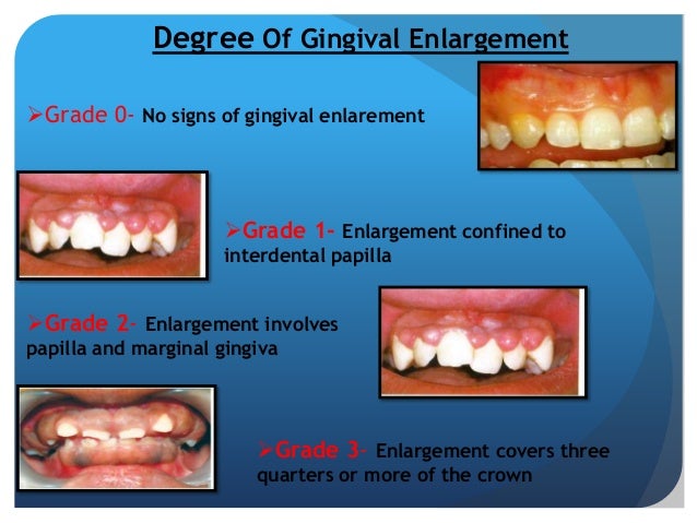 Gingival Enlargement