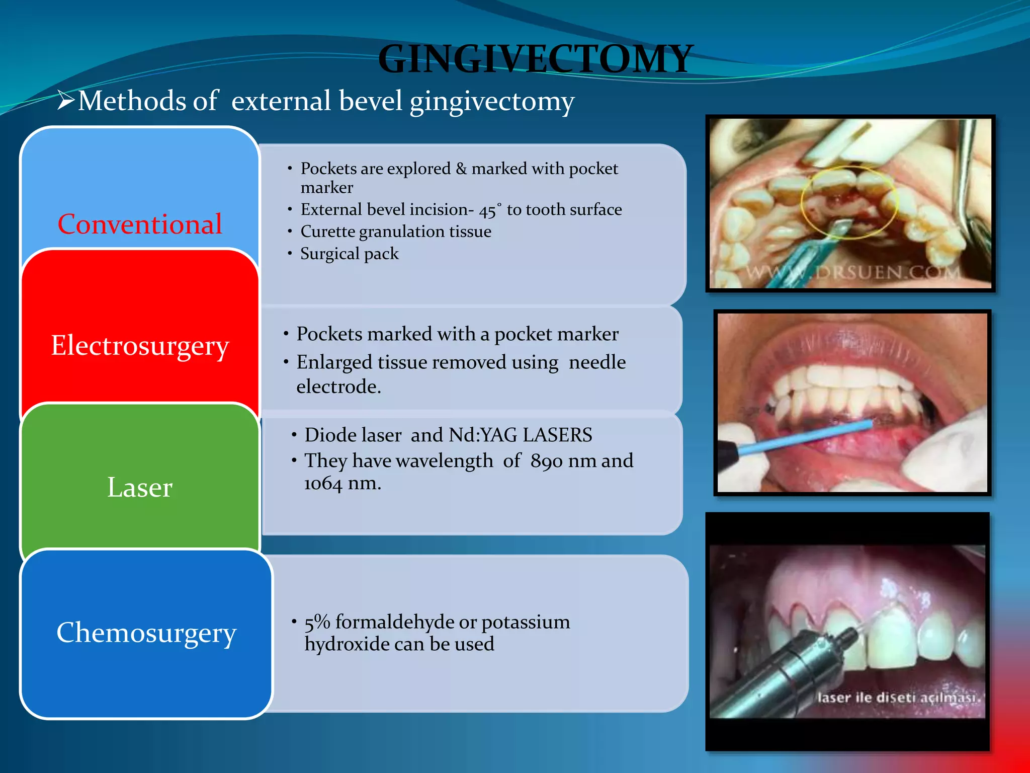 Gingivalenlargement 140610101542-phpapp01 | PPTX