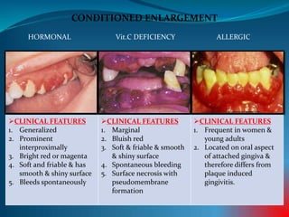 Gingival enlargement | PPTX