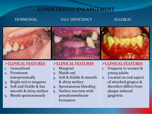 Gingival enlargement