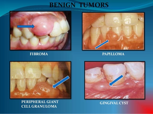 Gingival enlargement