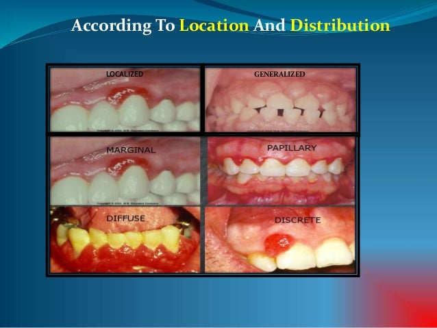 Gingival enlargement