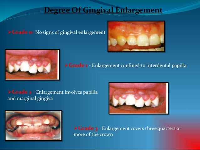Gingival enlargement