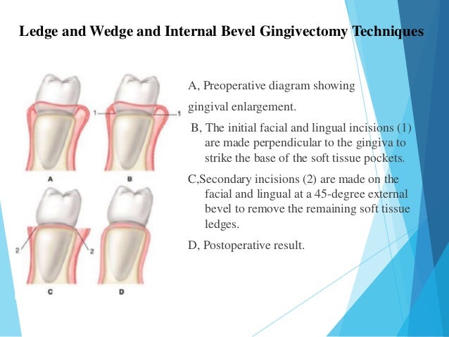 Gingival enlargement