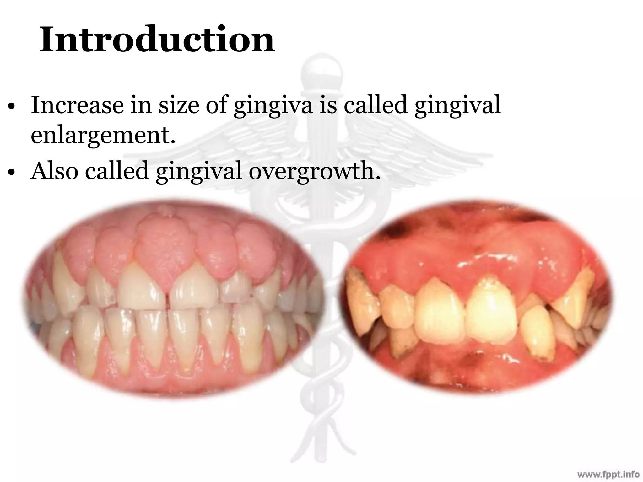 Gingival enlargement | PPTX