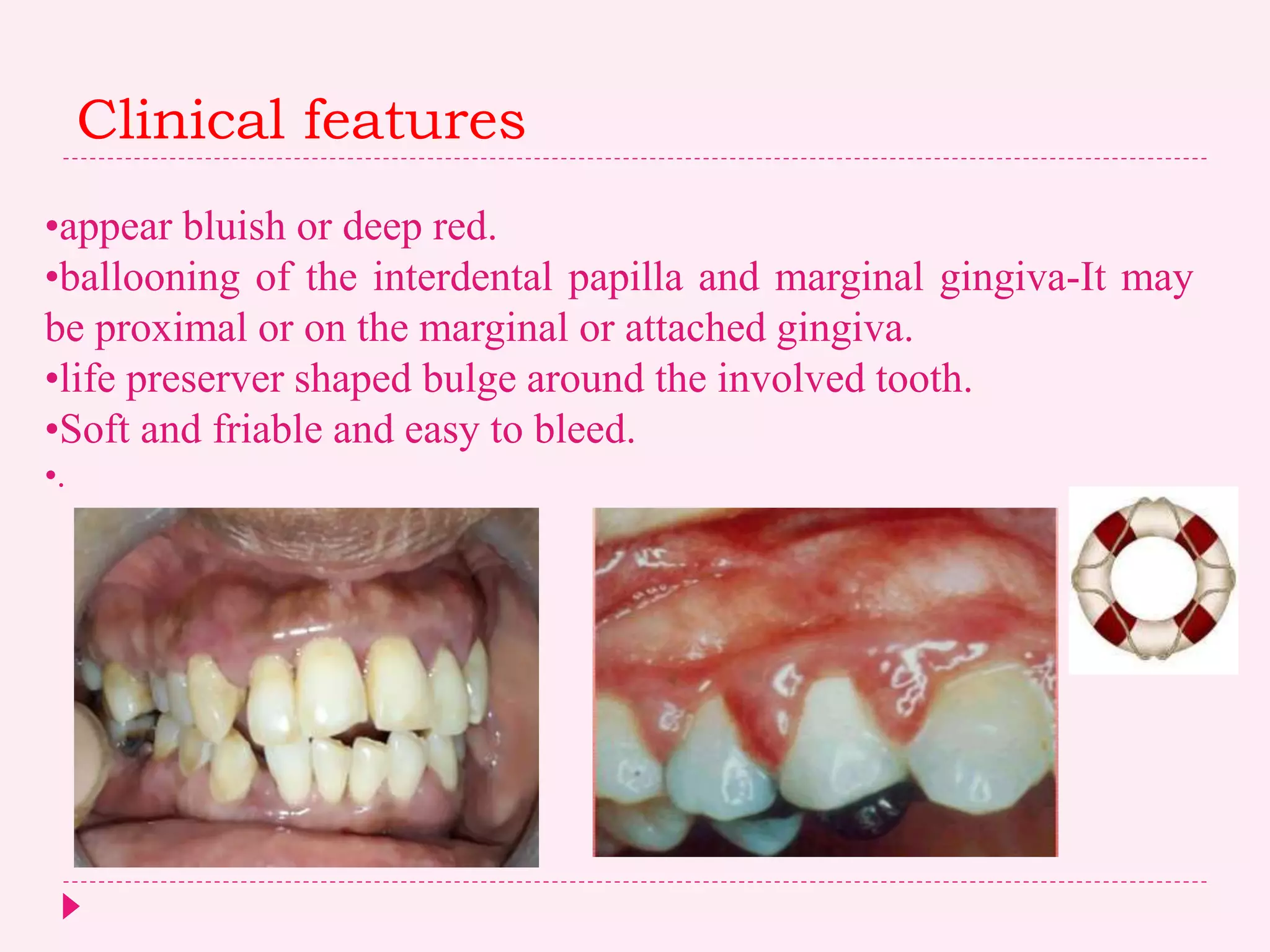 Gingival enlargement | PPTX