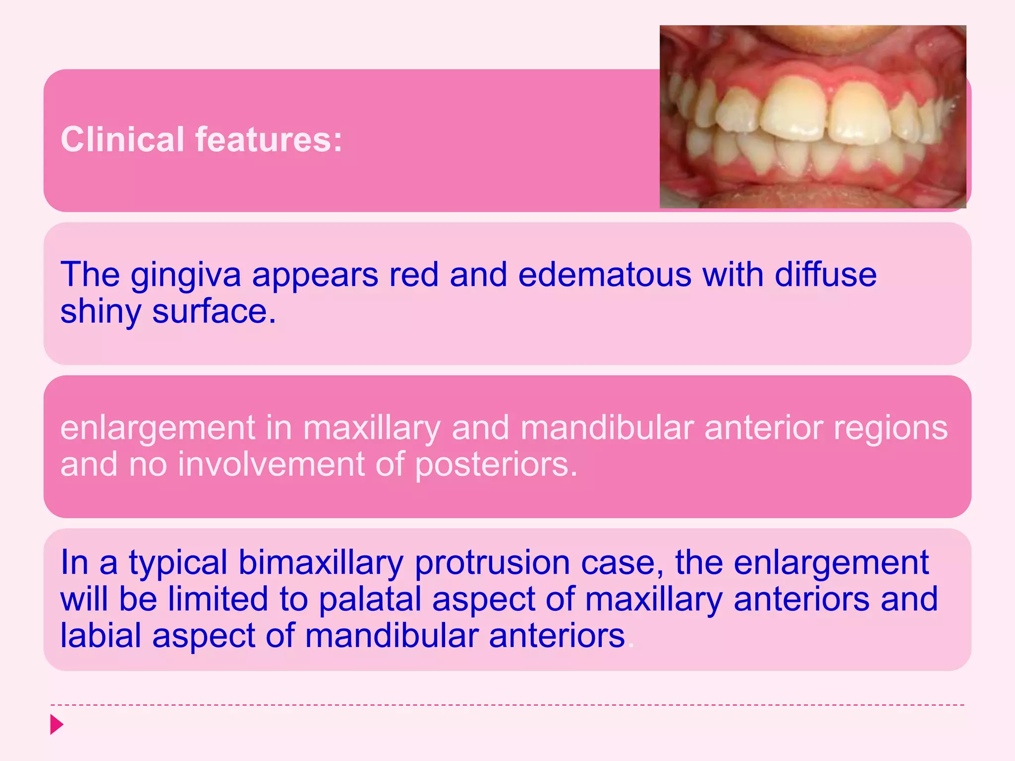 Gingival enlargement | PPTX