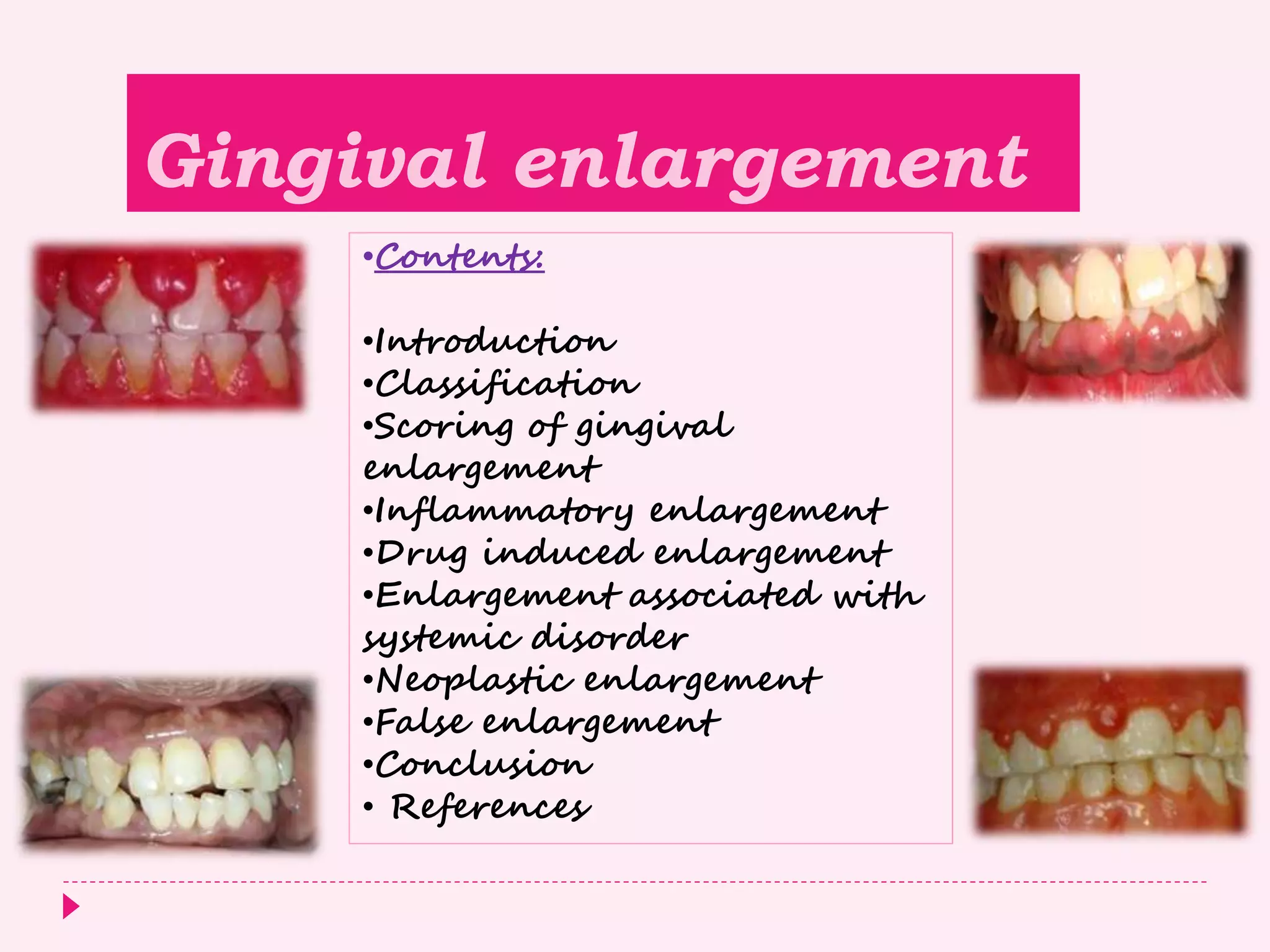 Gingival enlargement | PPTX