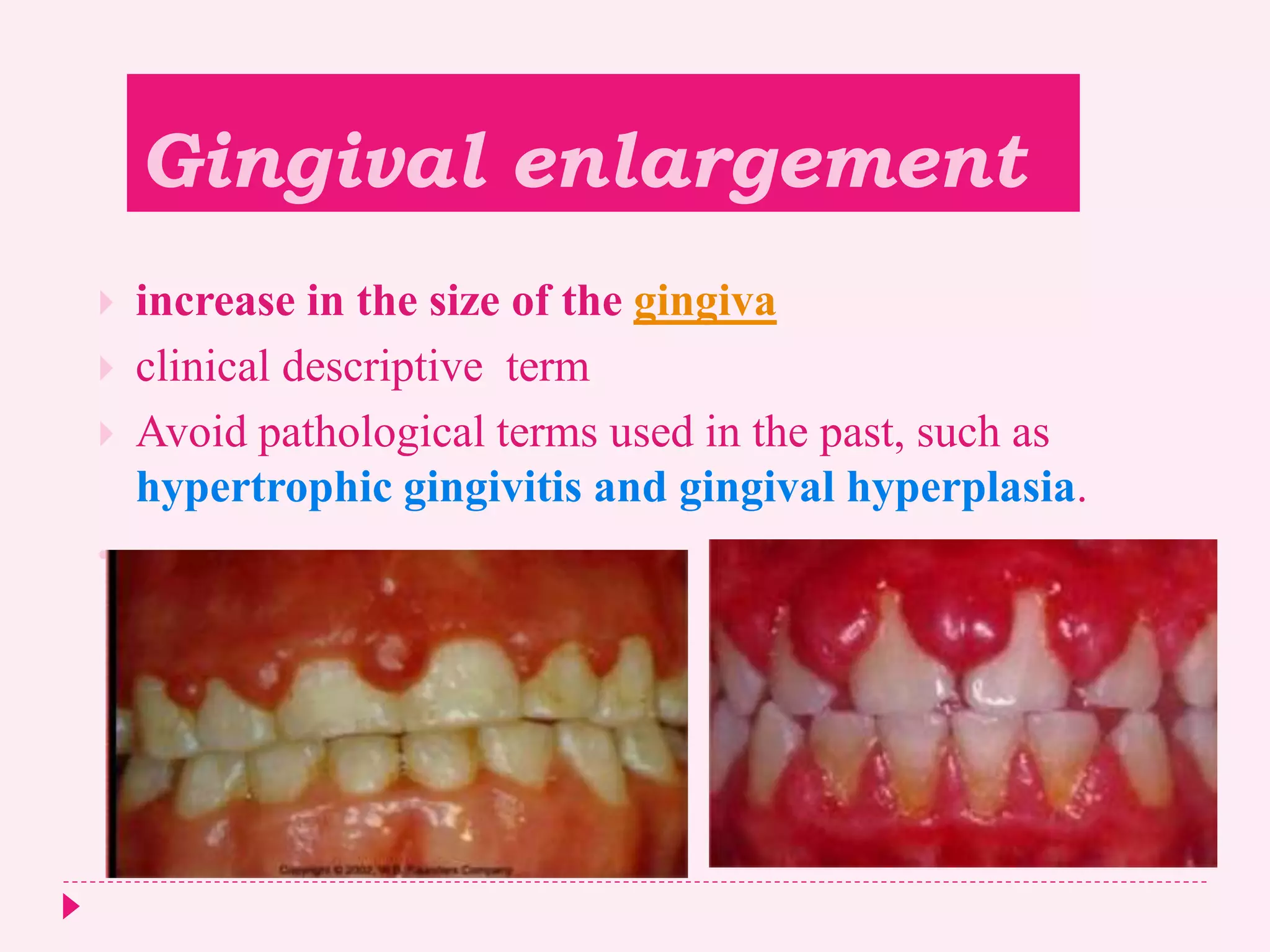 Gingival enlargement | PPTX