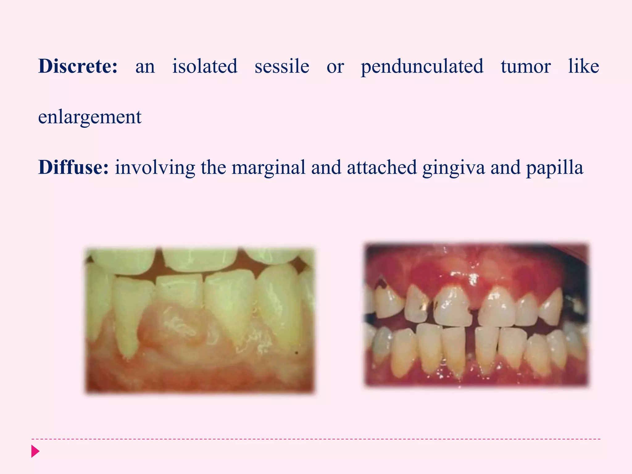 Gingival enlargement | PPTX