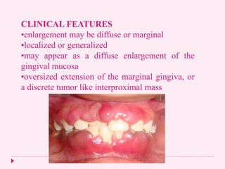 Gingival enlargement | PPTX