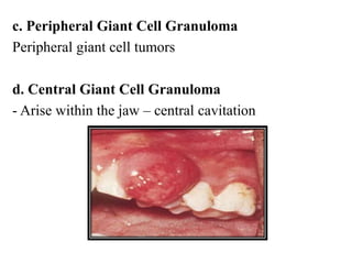 Gingival enlargement | PPTX