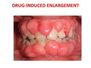 Gingival enlargement | PPTX