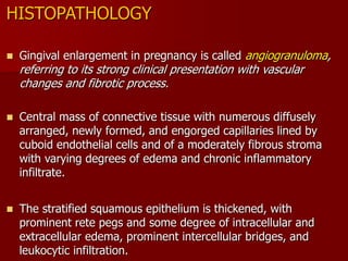 Gingival Enlargement.ppt