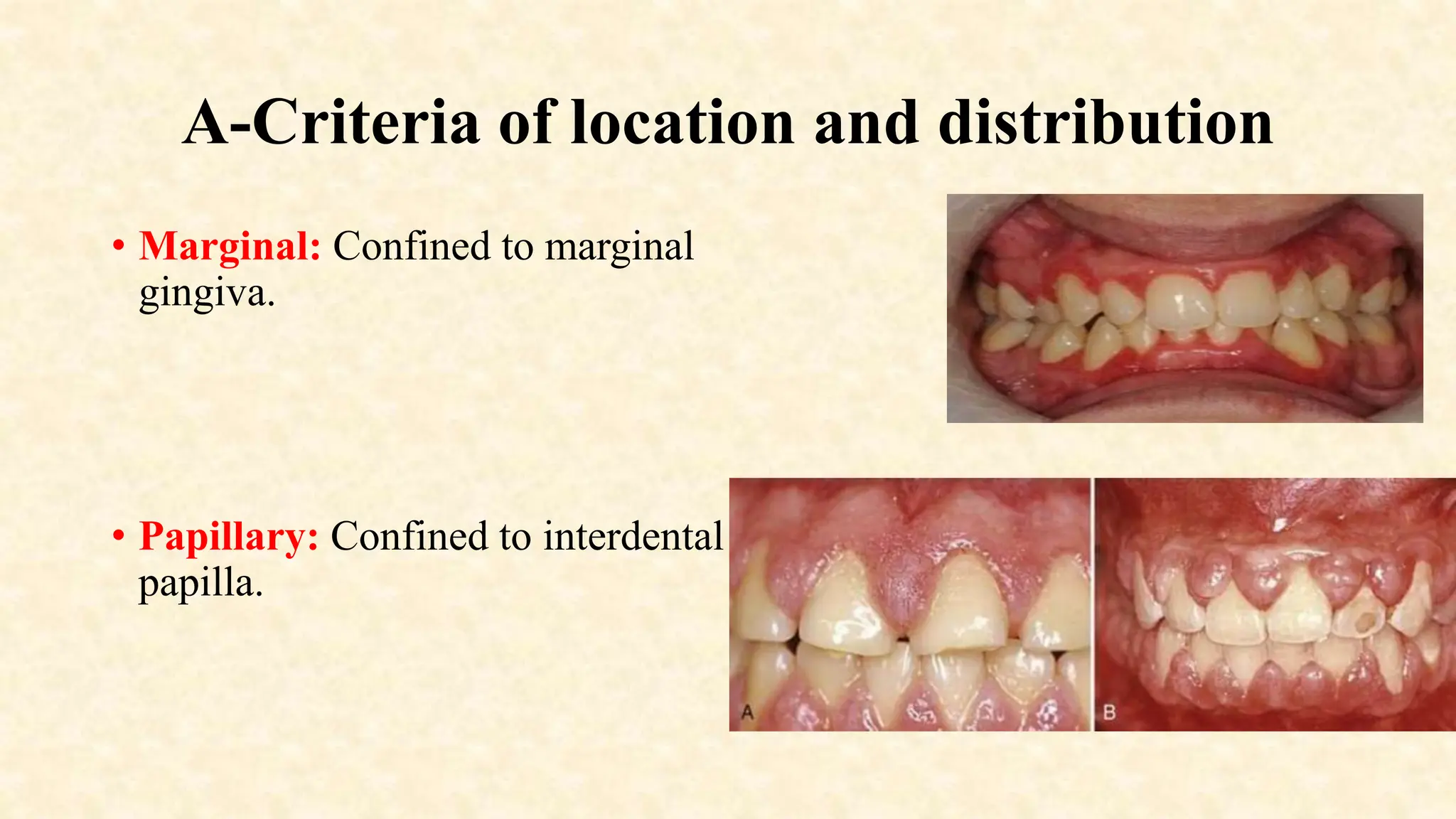 Gingival Enlargementdental periodontal.pptx
