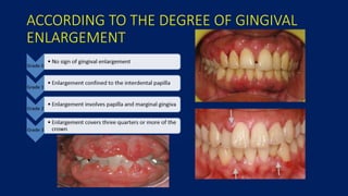 GINGIVAL ENLARGEMENT for dental students | PPTX | Dental Health ...
