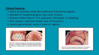 Gingival Enlargement Periodontology Persentaty | PDF