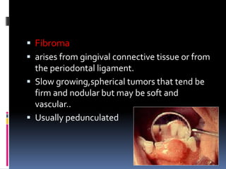 Gingival Enlargement- II.pp