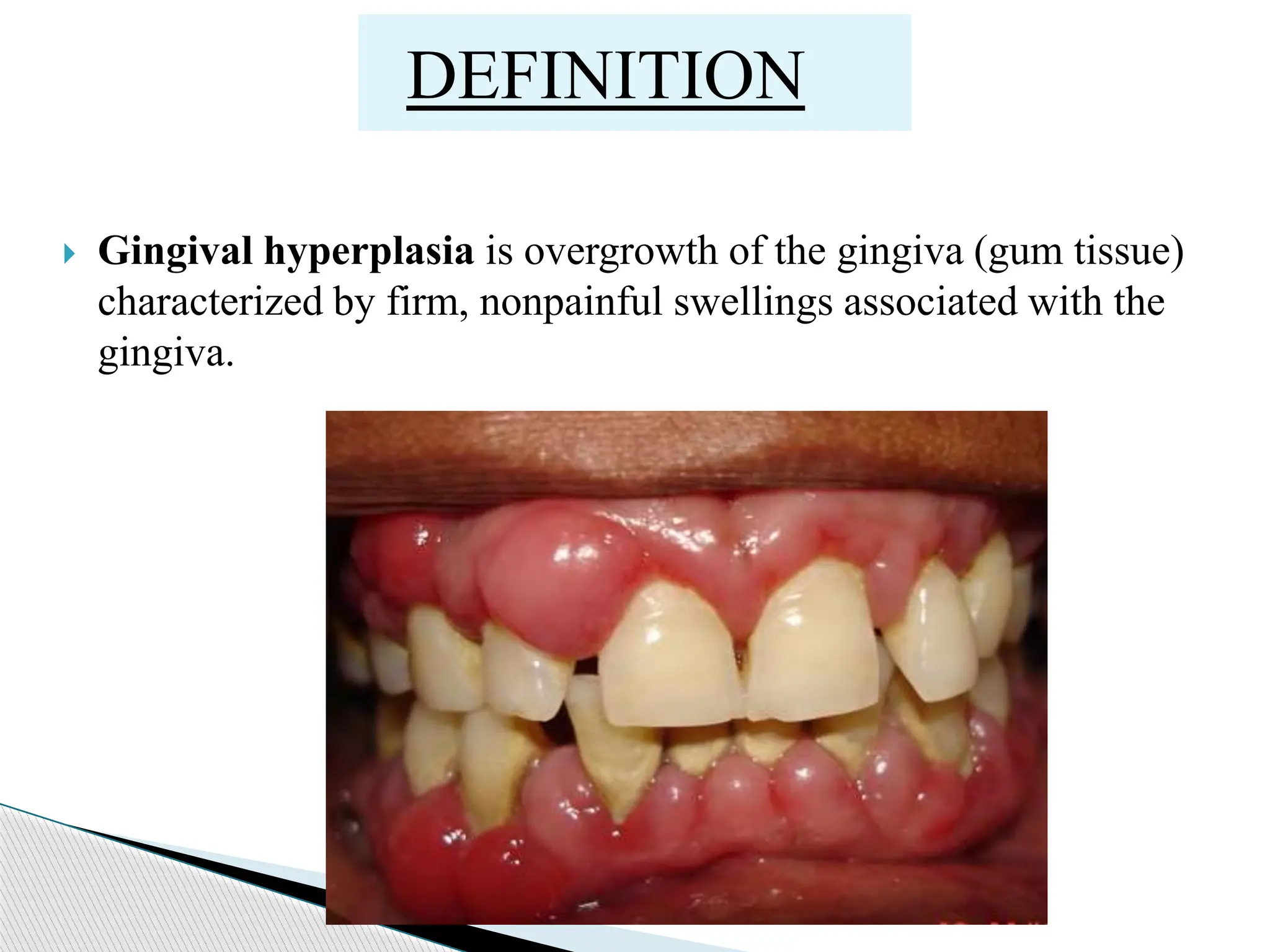 gingival enlargement 12.pptx department of periodontics | PPTX