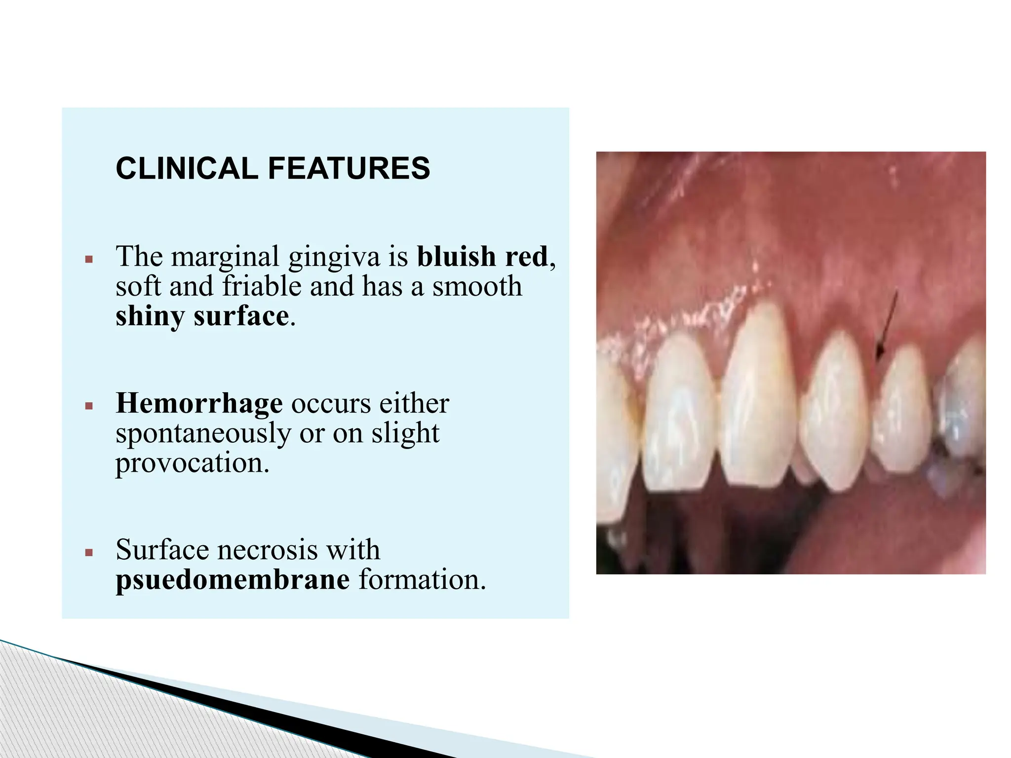 gingival enlargement 12.pptx department of periodontics | PPTX