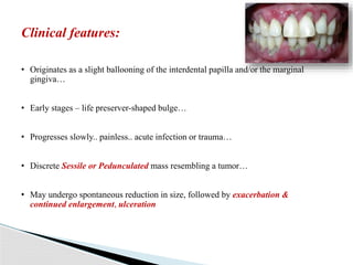 gingival enlargement 12.pptx department of periodontics | PPTX