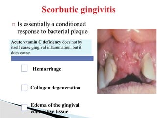 gingival enlargement 12.pptx department of periodontics | PPTX