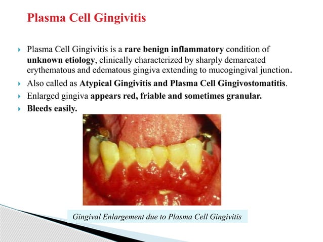 gingival enlargement 12.pptx department of periodontics | PPT