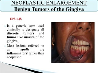 gingival enlargement 12.pptx department of periodontics | PPTX