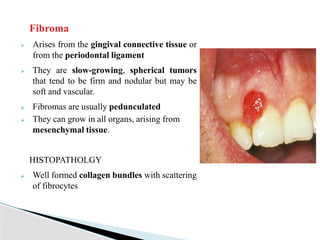 gingival enlargement 12.pptx department of periodontics | PPTX