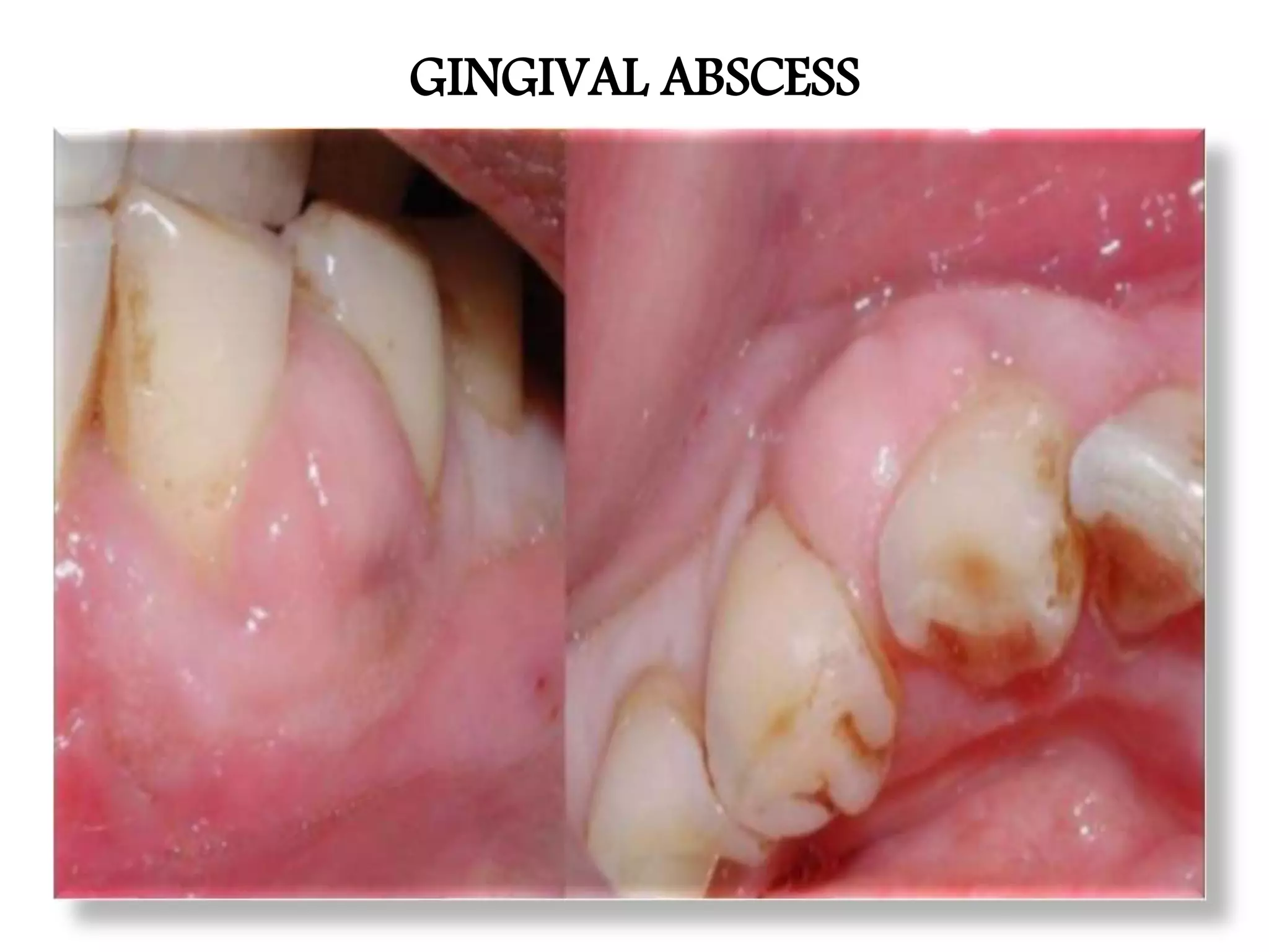 "GINGIVAL-ENLARGEMENT" | PPTX