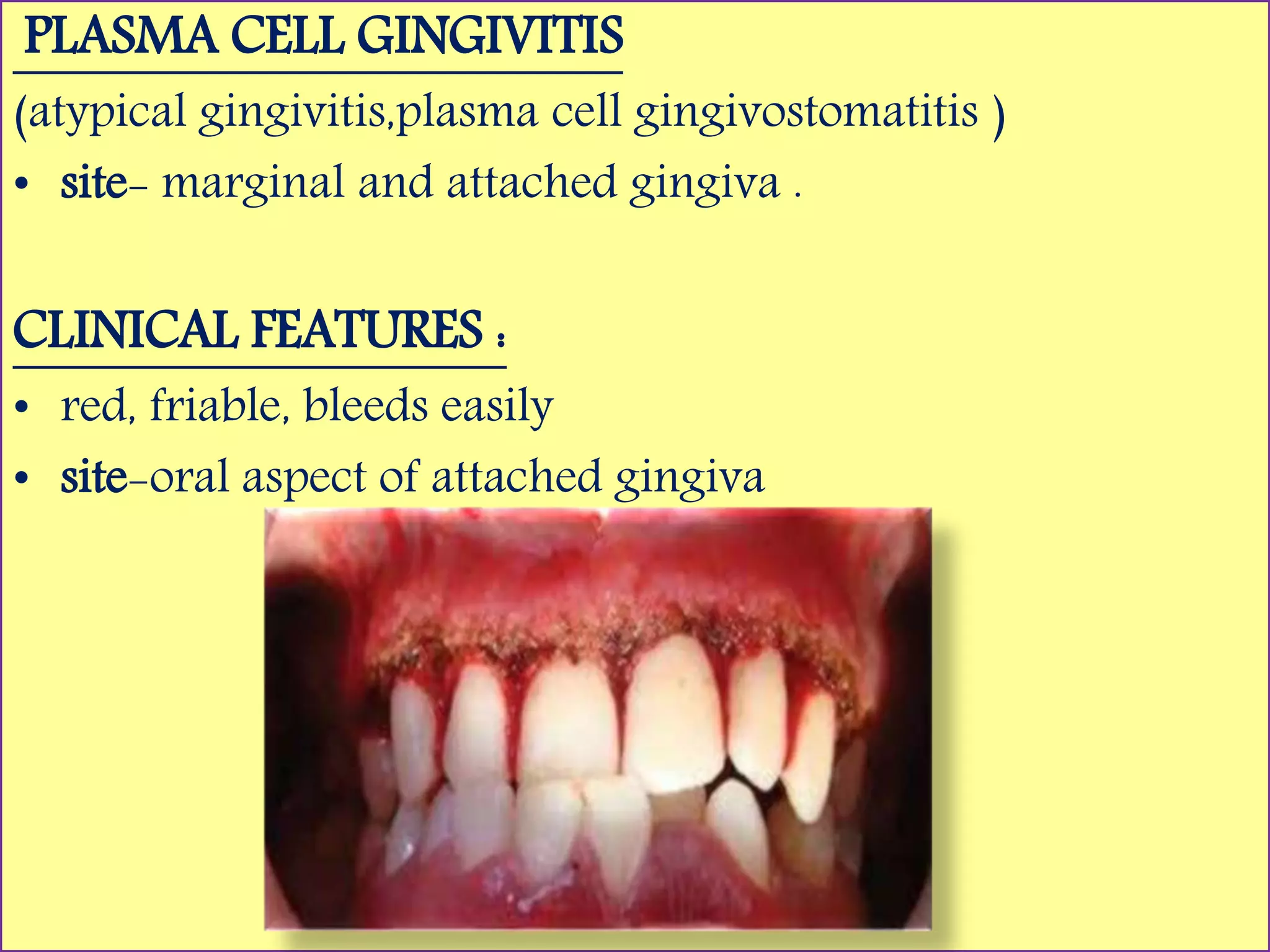 "GINGIVAL-ENLARGEMENT" | PPTX