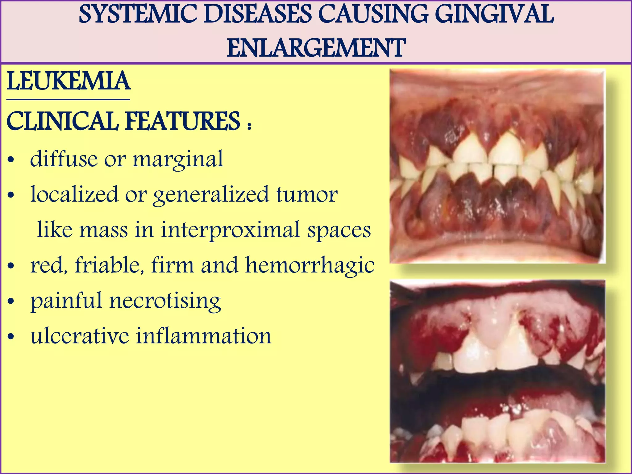 "GINGIVAL-ENLARGEMENT" | PPTX | Oral care | Personal Care