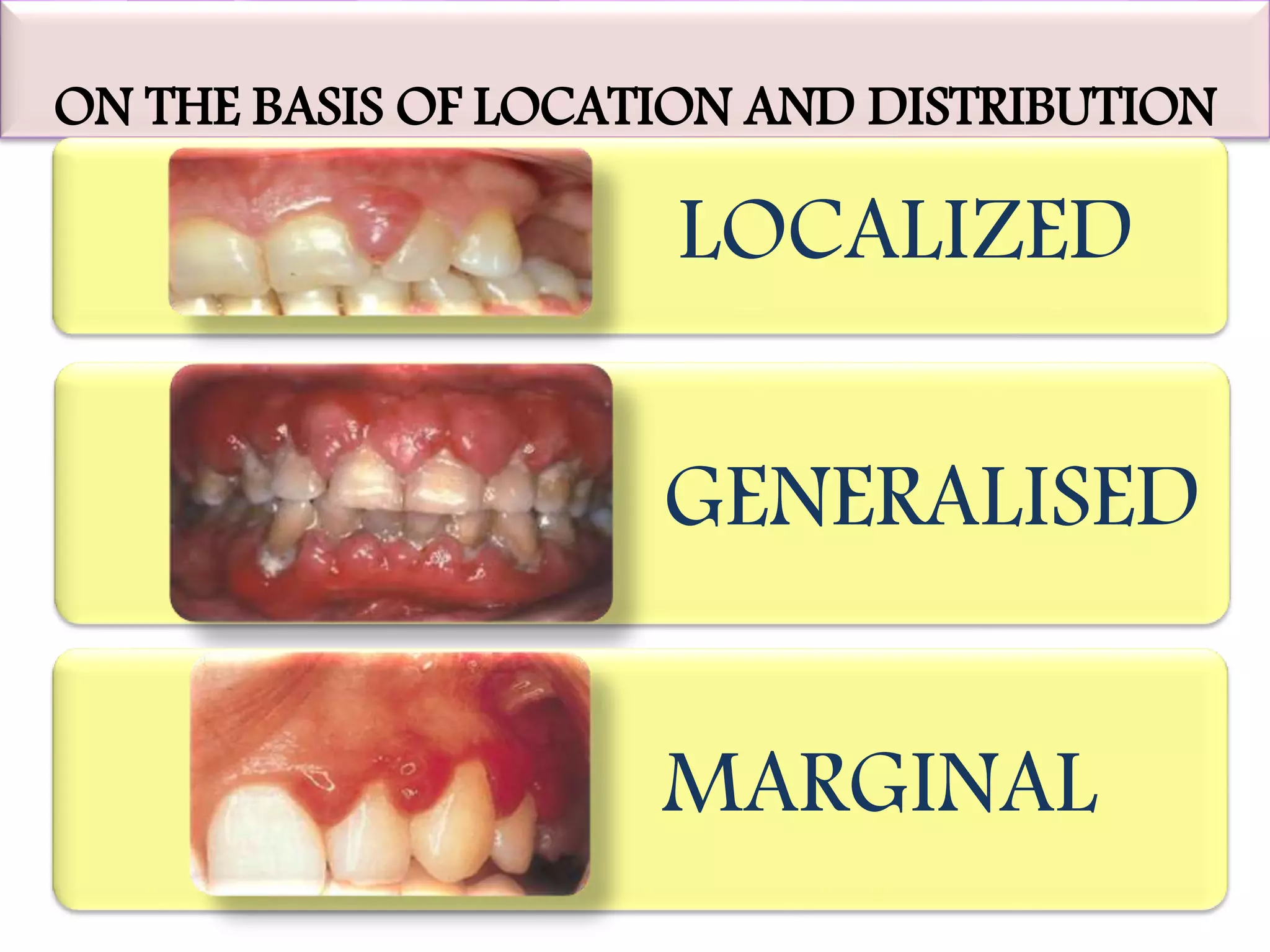 "GINGIVAL-ENLARGEMENT" | PPTX
