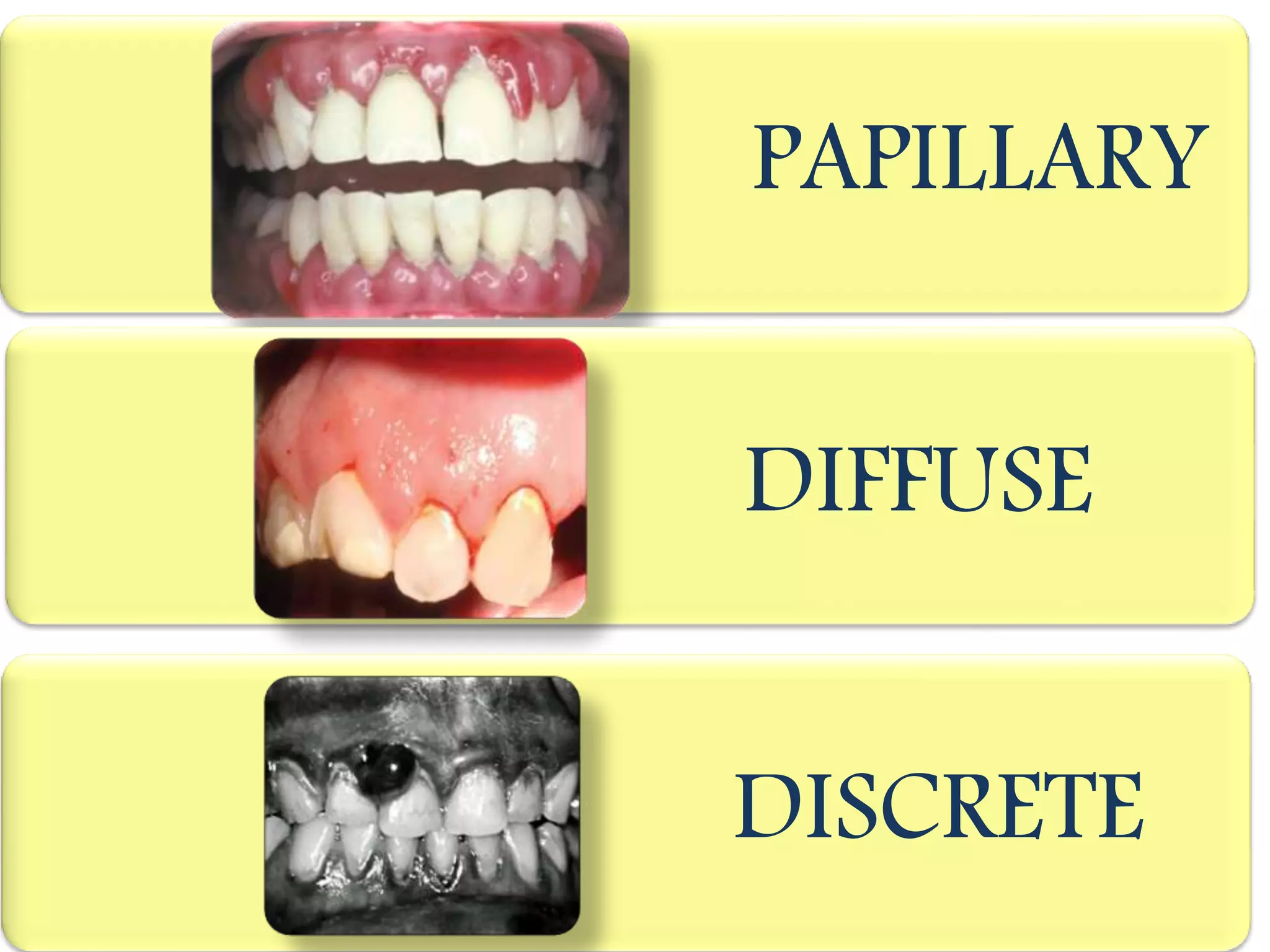 "GINGIVAL-ENLARGEMENT" | PPTX
