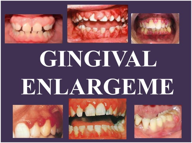 "GINGIVAL-ENLARGEMENT" | PPTX | Oral care | Personal Care