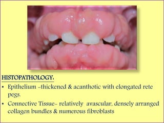"GINGIVAL-ENLARGEMENT" | PPTX