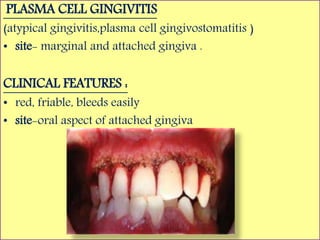 "GINGIVAL-ENLARGEMENT" | PPTX