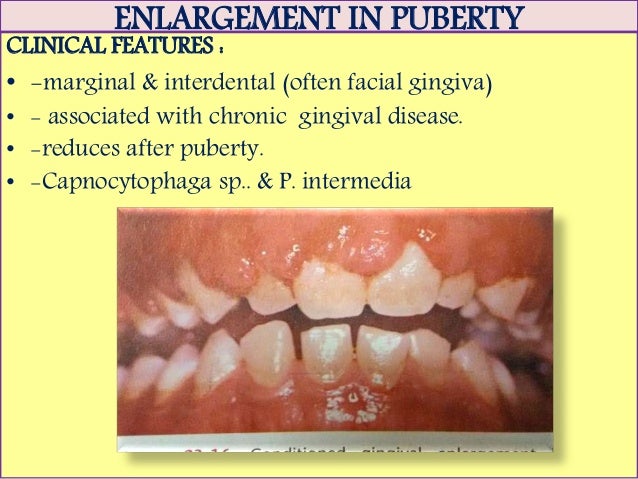 "GINGIVAL-ENLARGEMENT"