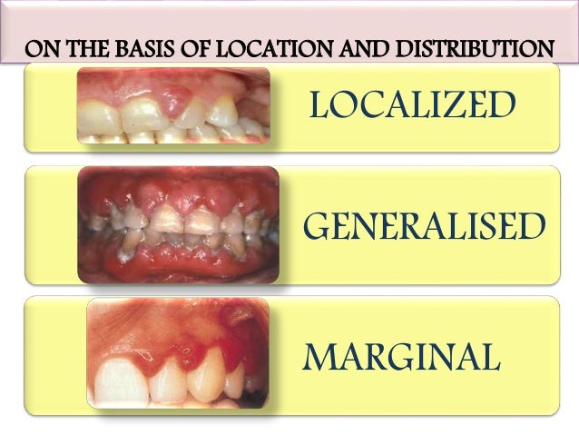 "GINGIVAL-ENLARGEMENT"
