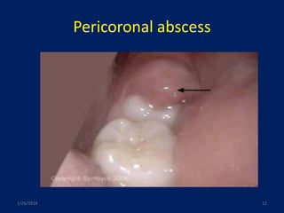 Gingival enlargements | PPTX