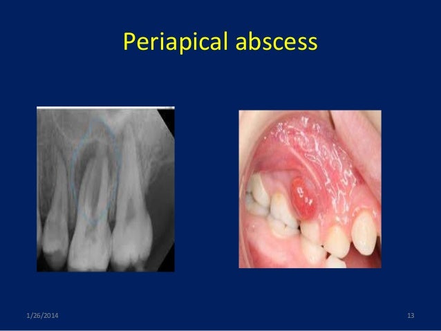 Gingival enlargements