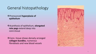 Gingival Hyperplasia Histology
