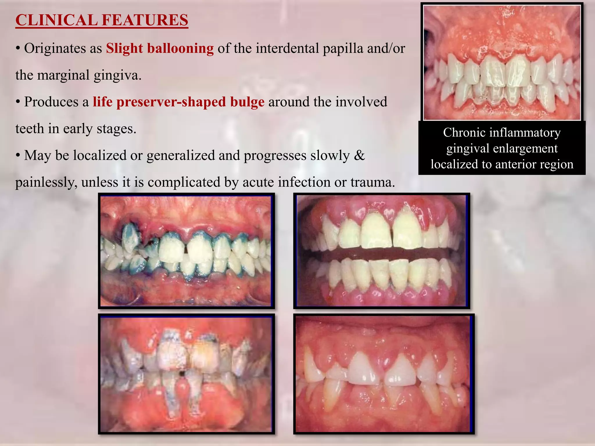 Gingival enlargment and its treatment | PPTX