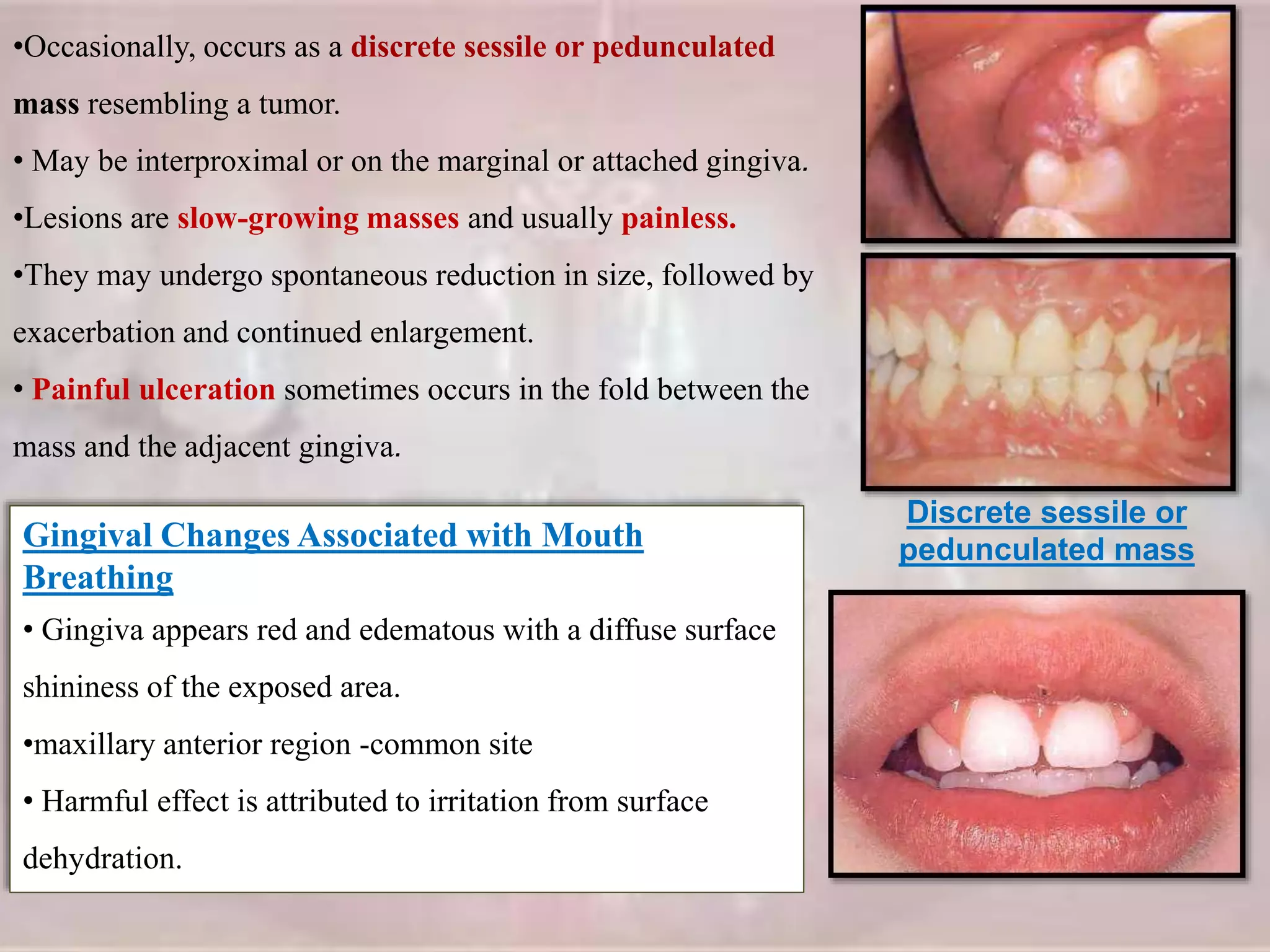 Gingival enlargment and its treatment | PPTX