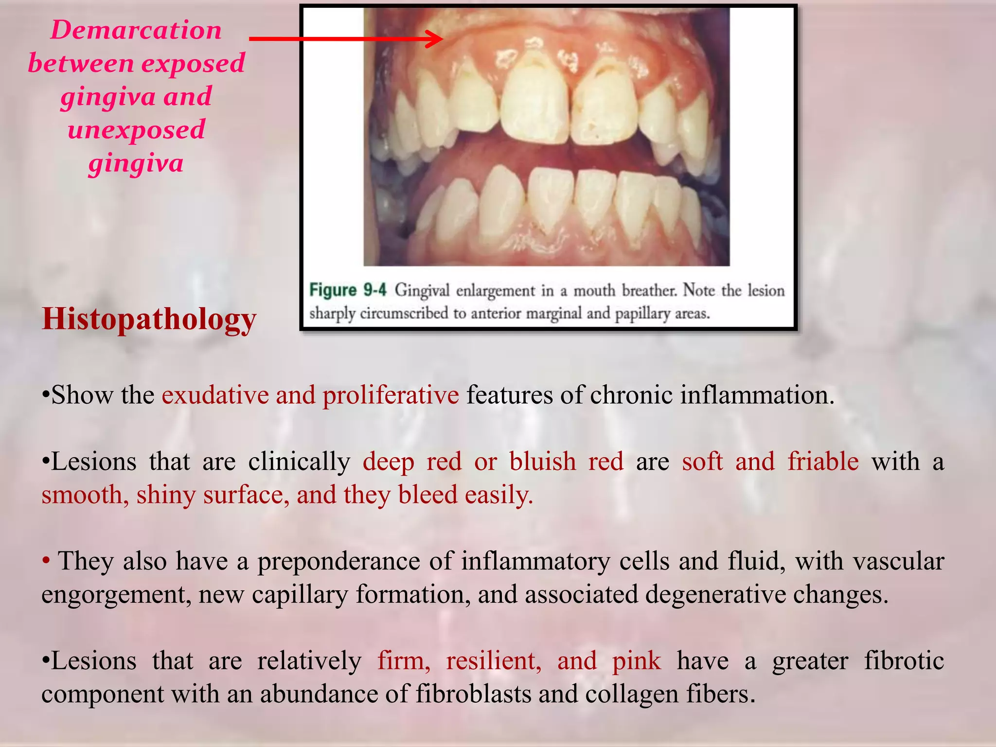 Gingival enlargment and its treatment | PPTX