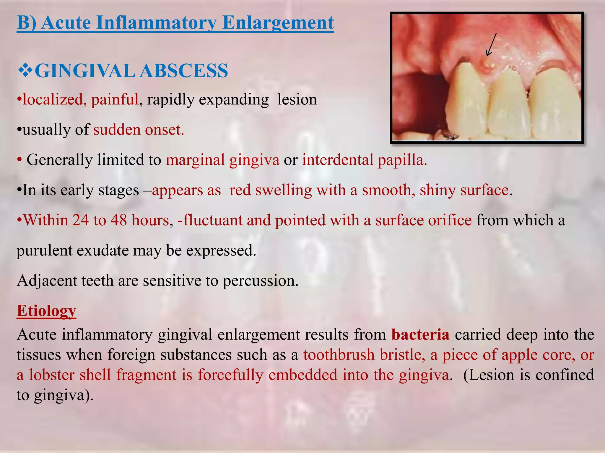 Gingival enlargment and its treatment | PPTX