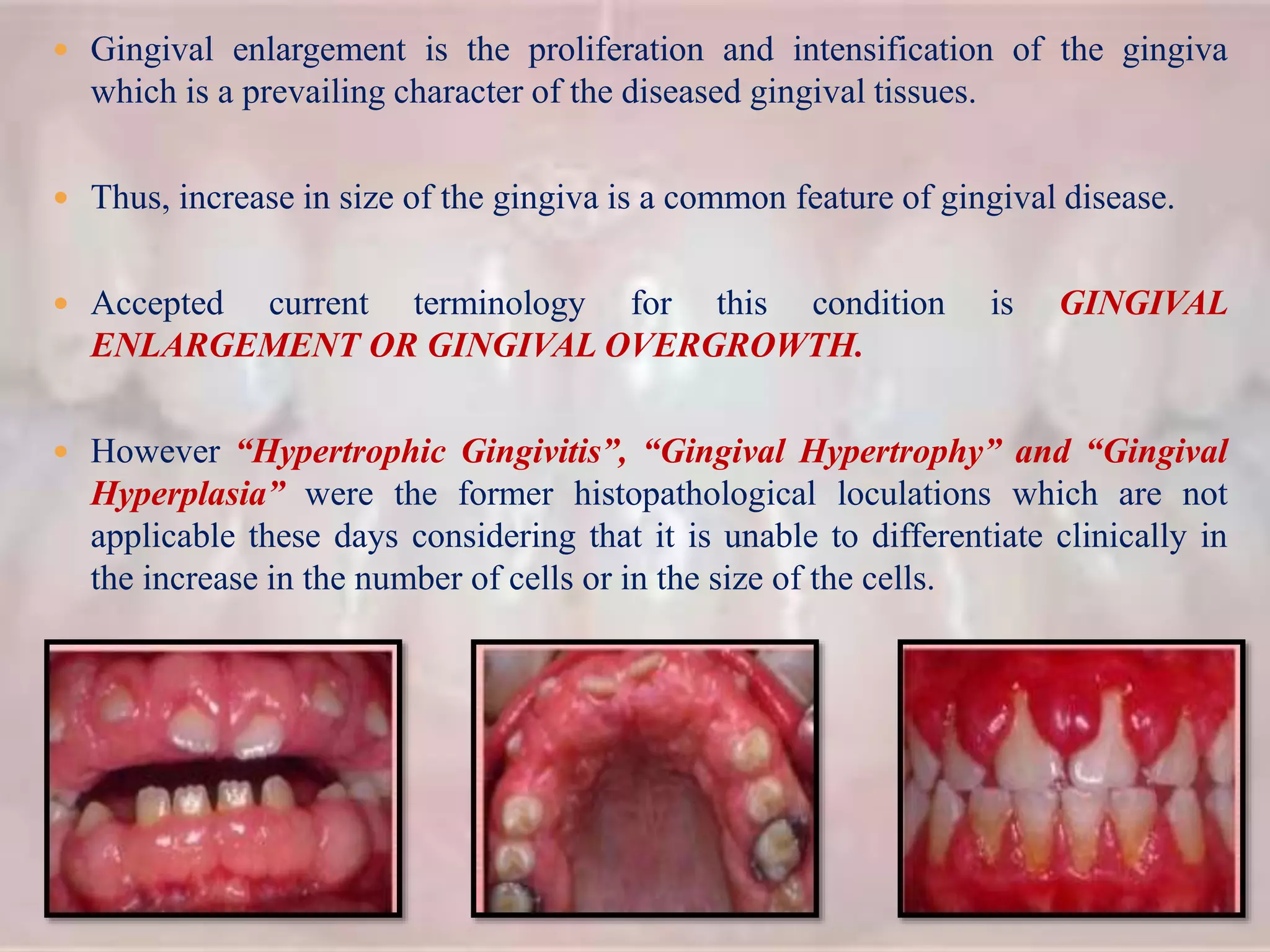 Gingival enlargment and its treatment | PPTX